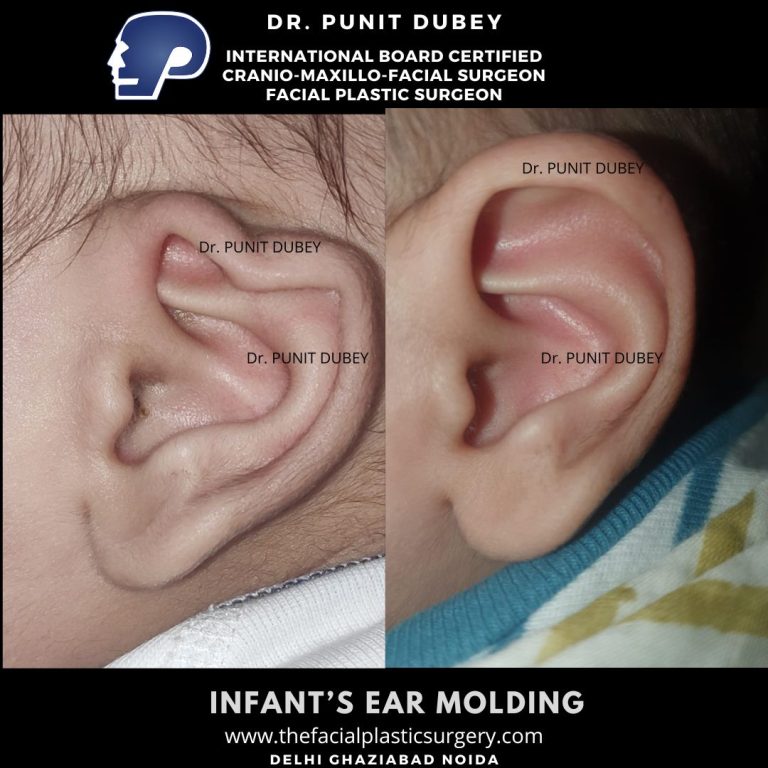 Infant Ear Molding In Delhi | Ear Molding By Dr. Punit Dubey