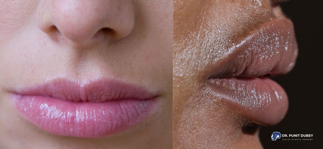 Lip Reduction Surgery In Delhi | Lip Reduction Surgery Cost In Delhi
