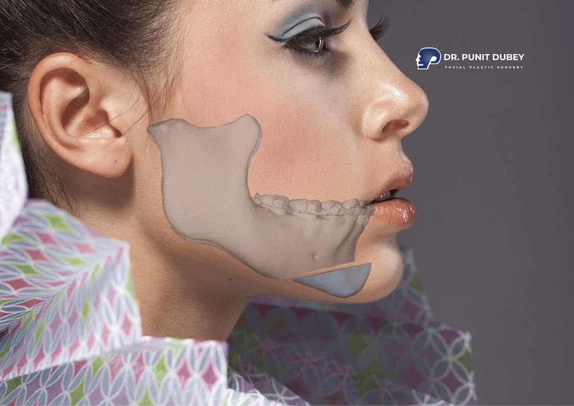 Genioplasty In Delhi | Genioplasty Cost In India