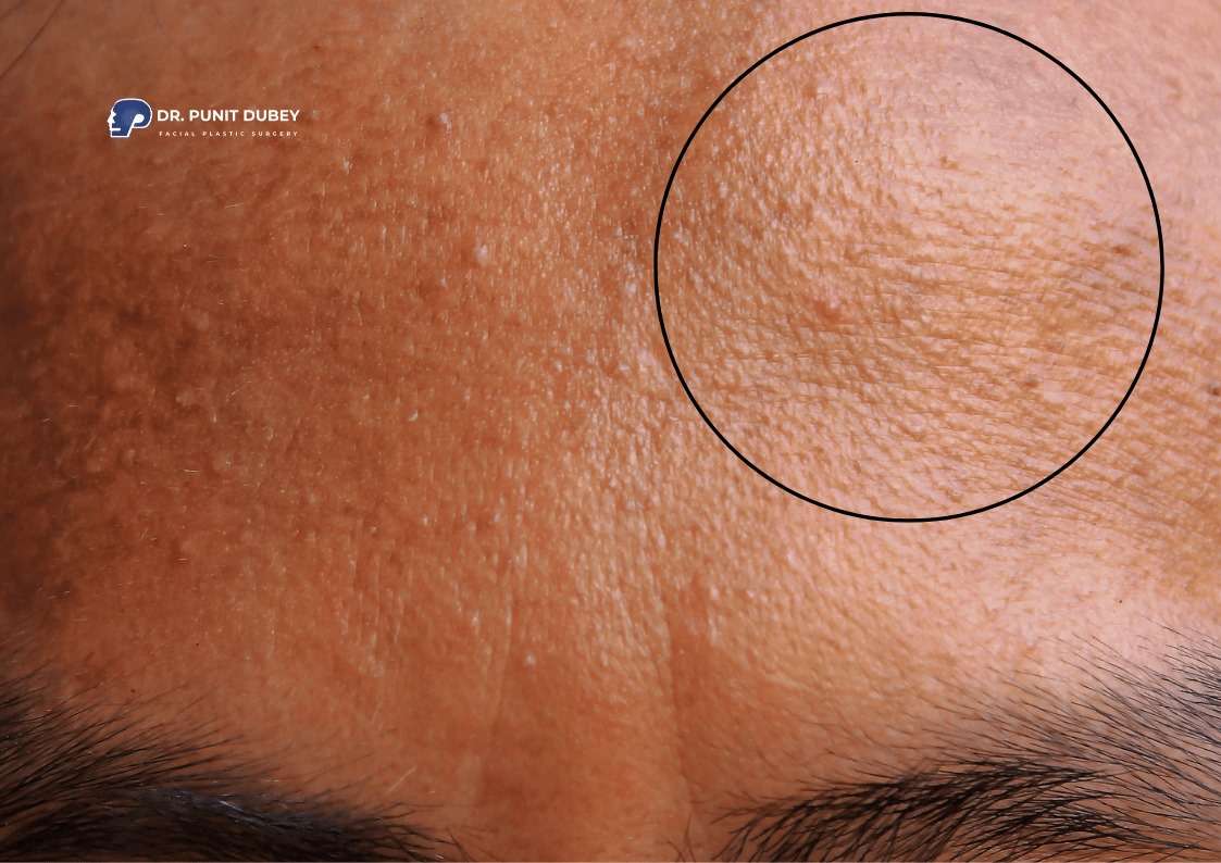 Osteoma Forehead Treatment In Delhi