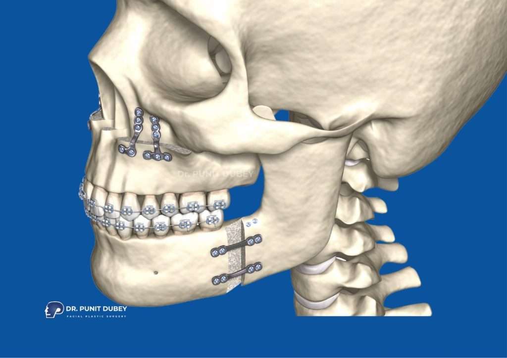 Jaw Surgery In Delhi | Jaw Surgery Cost In Delhi