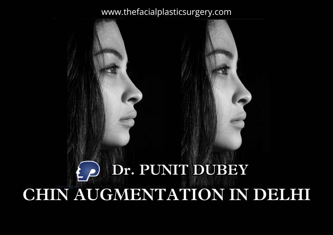 Chin Augmentation In Delhi | Chin Augmentation Cost In India