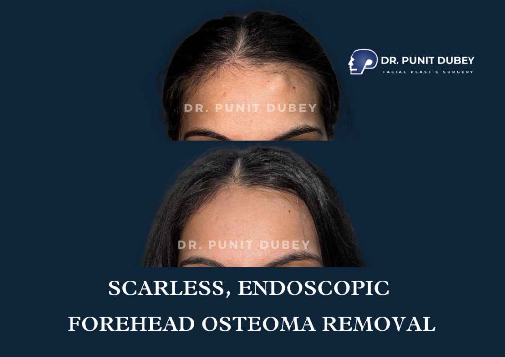 Osteoma Forehead Treatment In Delhi