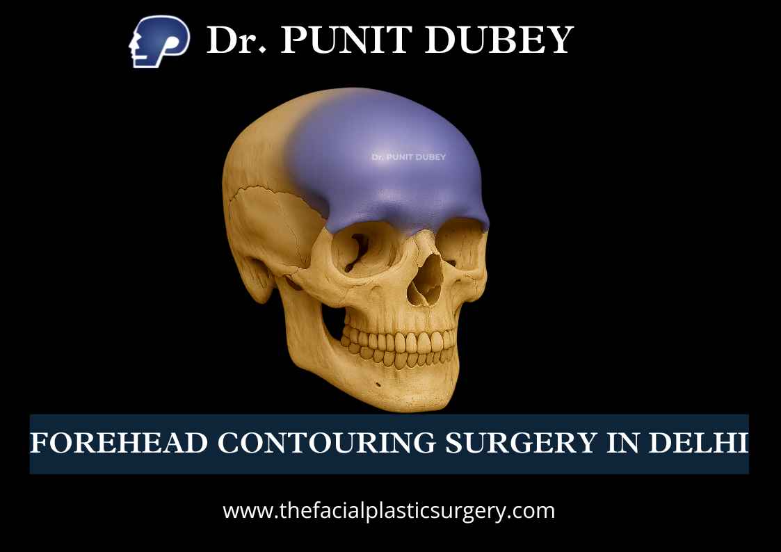 Forehead Contouring Surgery In Delhi- Forehead Augmentation