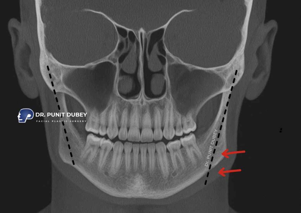 Jaw Reduction Surgery In Delhi-Wide & Square Jaw Surgery
